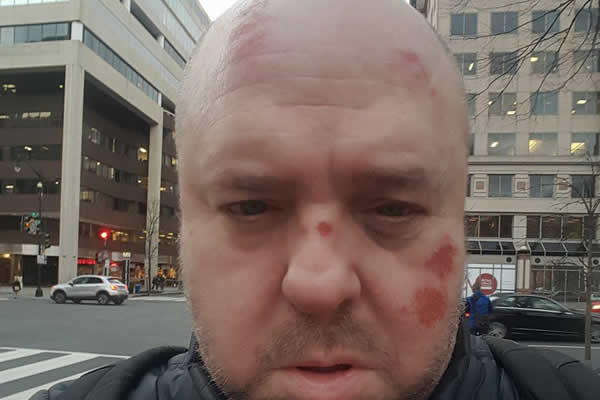 Hate crime: D.C. man attacked by pack of violent Trump supporters ...