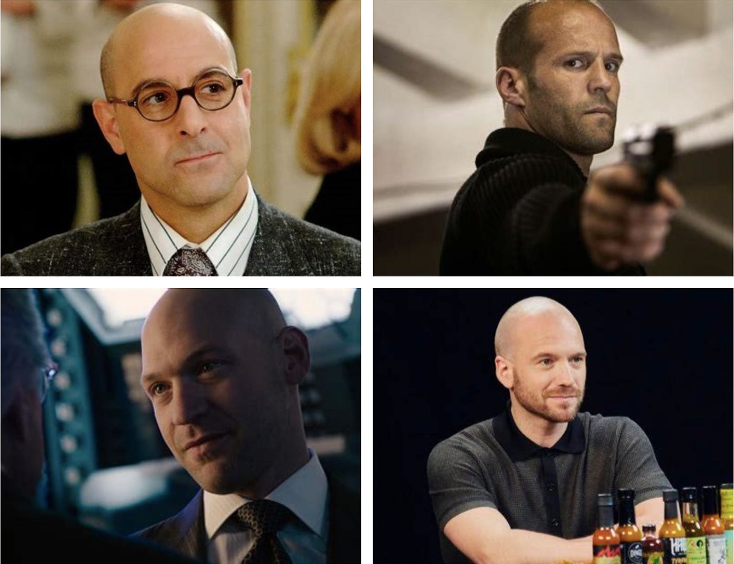Going bald at age 19 was incredibly traumatic. But now I'm glad it ...